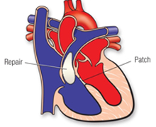 Tetralogy of Fallot – Seattle Children’s