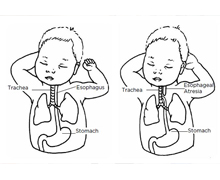 Tracheoesophageal Fistula and Esophageal Atresia